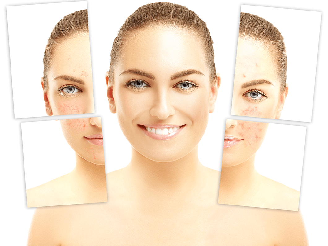What is Acne and Why? – ZONE® DERMASURE®